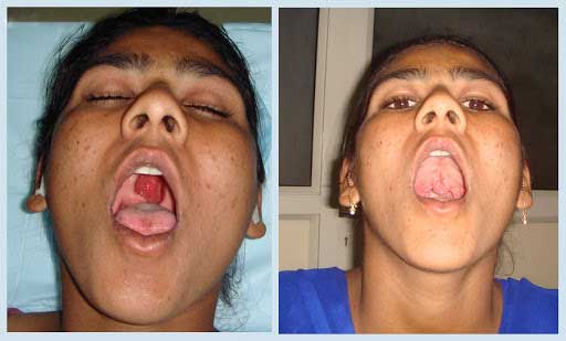 Yarık Damak Hastalığı Hakkında Merak Edilenler - Dudak Damak Yarıkları